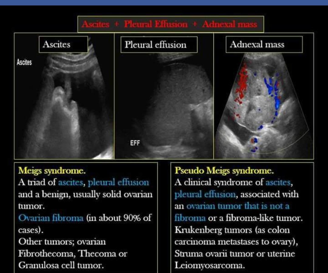 Ascites Vs Pleural Effusion Ultrasound