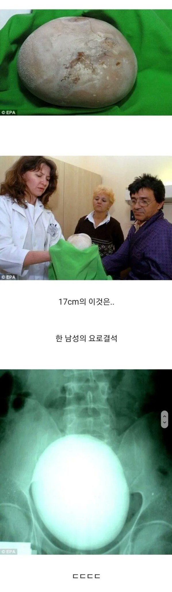 인스티즈(instiz) on Twitter: "한 남성의 몸 속에서 나왔다는 요로결석.. https://t.co/3JoFFpvdeT https://t.co ...