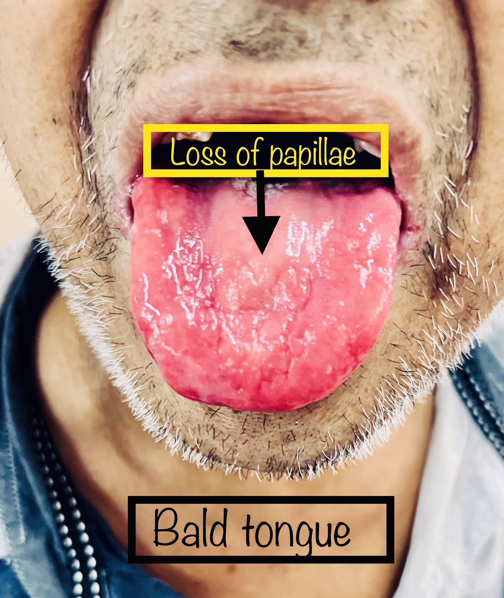 Atrophic Filiform Papillae Florid Geographic Tongue MEDizzy