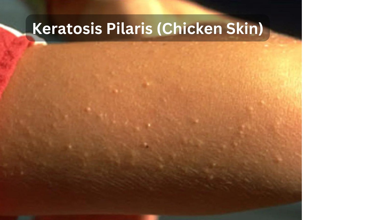 Chicken Skin On Legs