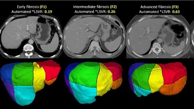 Radiology: Artificial Intelligence on Twitter: "#DL model predicts #cirrhosis and advanced ...