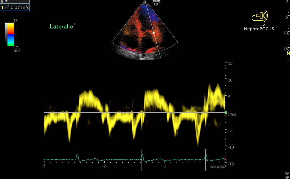 Diastology question for experts. Image obtained in #Nephrology clinic ...