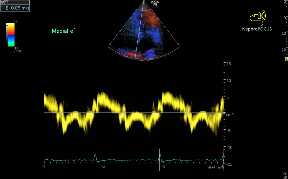 Diastology question for experts. Image obtained in #Nephrology clinic ...