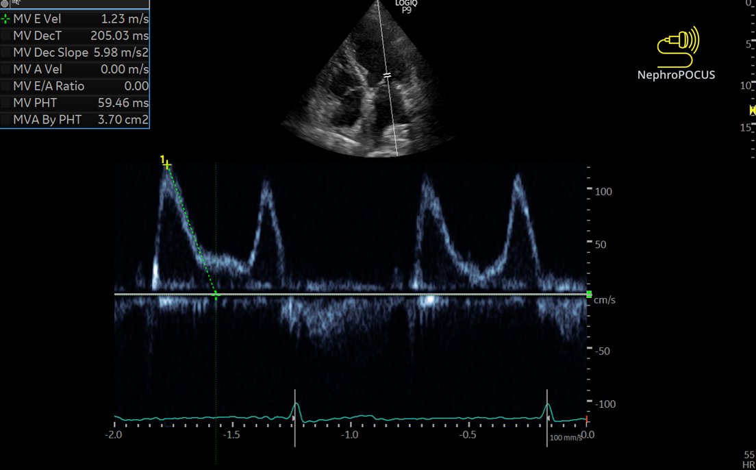 Diastology question for experts. Image obtained in #Nephrology clinic ...