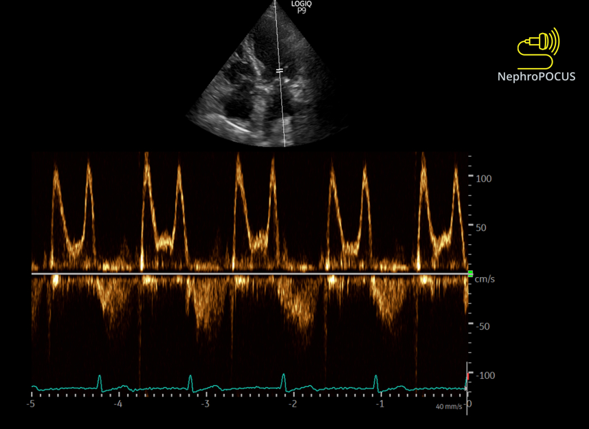 Diastology question for experts. Image obtained in #Nephrology clinic ...