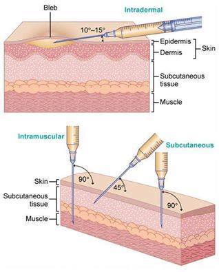 Bleb Intradermal Injection