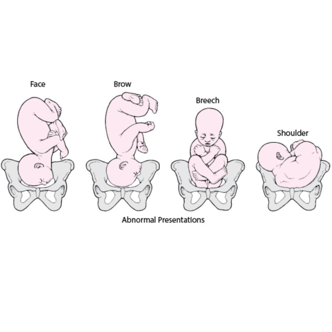 THREAD WHY U WOULD CHOOSE CESAREAN SECTION(CS) OVER A VAGINAL DELIVERY ...