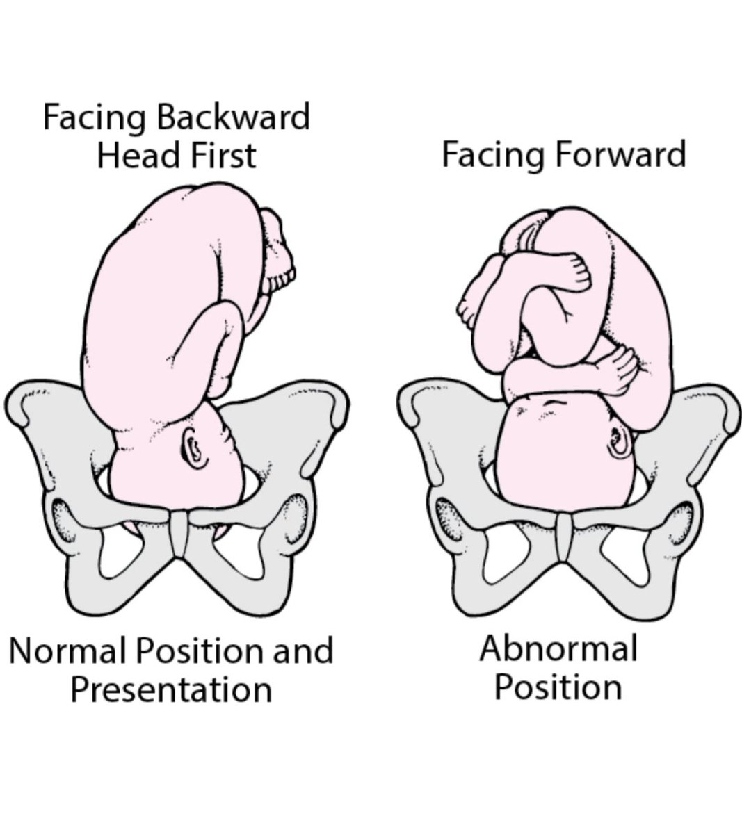 THREAD WHY U WOULD CHOOSE CESAREAN SECTION(CS) OVER A VAGINAL DELIVERY ...