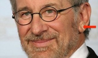 من المهم فحص شحمة الأذن بحثًا عن علامات محتملة لخطر الإصابة #بالسكتة ...