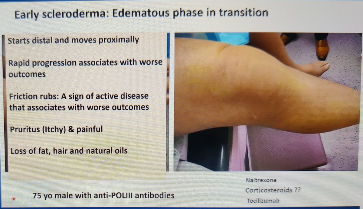 Philip S Hench memorial lecture: Scleroderma 2022 by Prof Fredrick ...