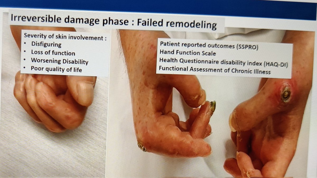 Philip S Hench memorial lecture: Scleroderma 2022 by Prof Fredrick ...