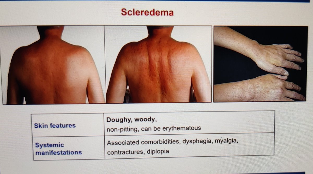 💭 of #myositis mimics if ABSENT 🔸Skin rash 🔸Other extra muscular ...