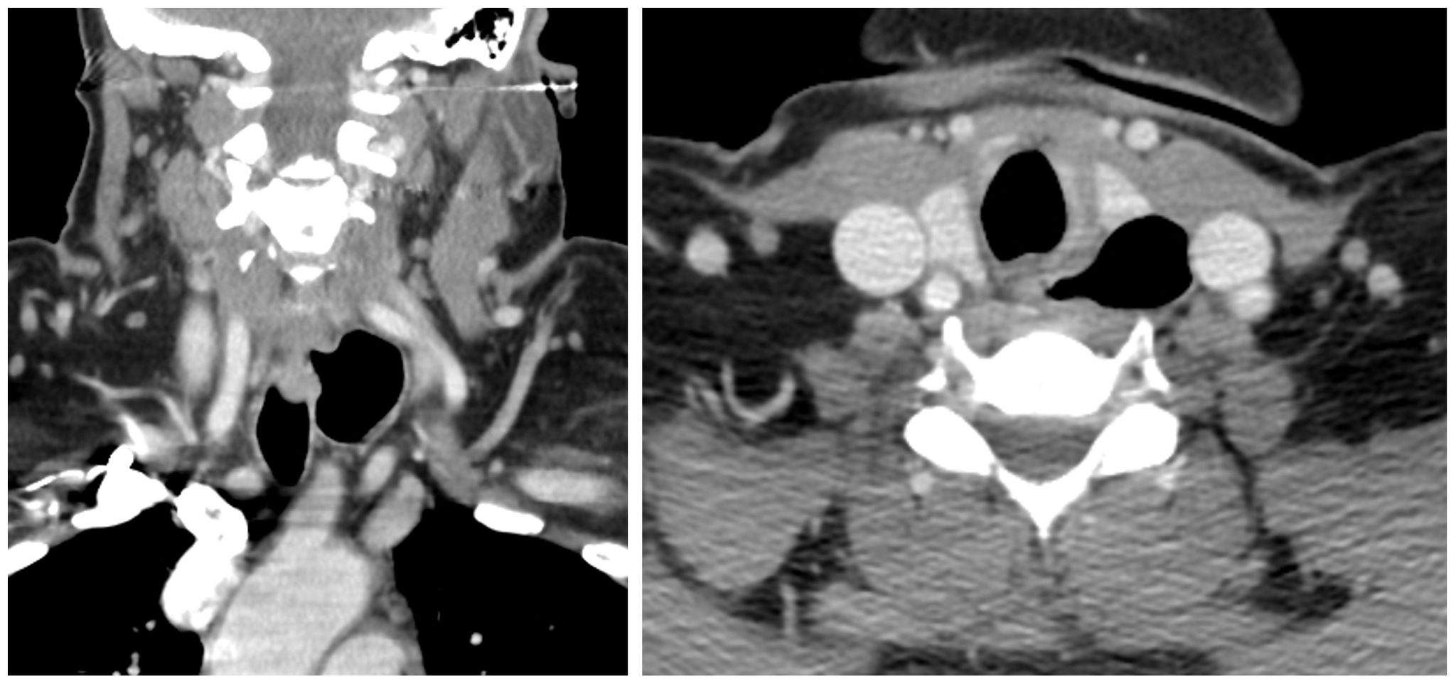 Killian Jamieson Diverticulum Laimer's Diverticulum, A Rare True