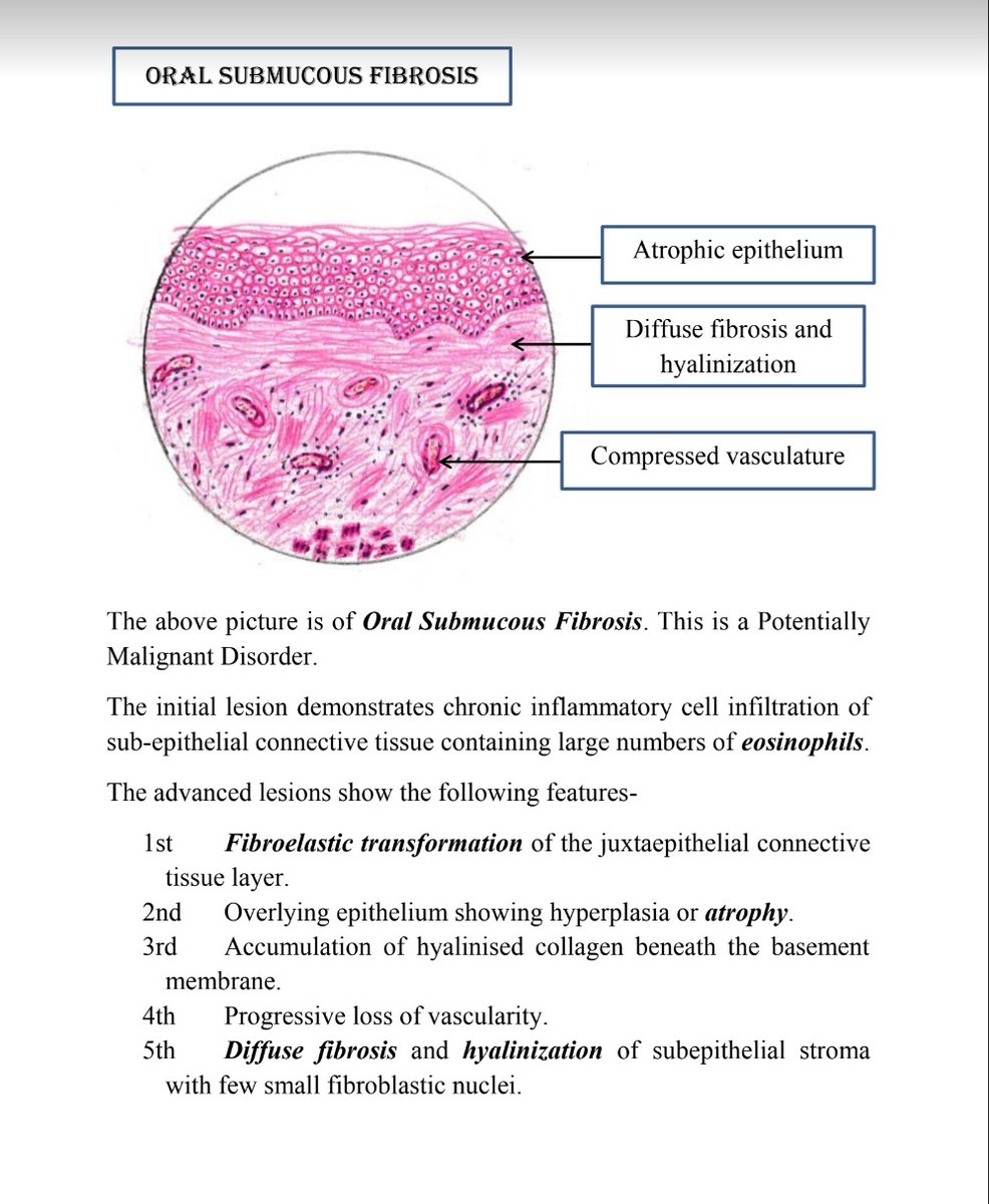 Oral Submucous Fibrosis Histology Fibrotic Matrix Induces Mesenchymal