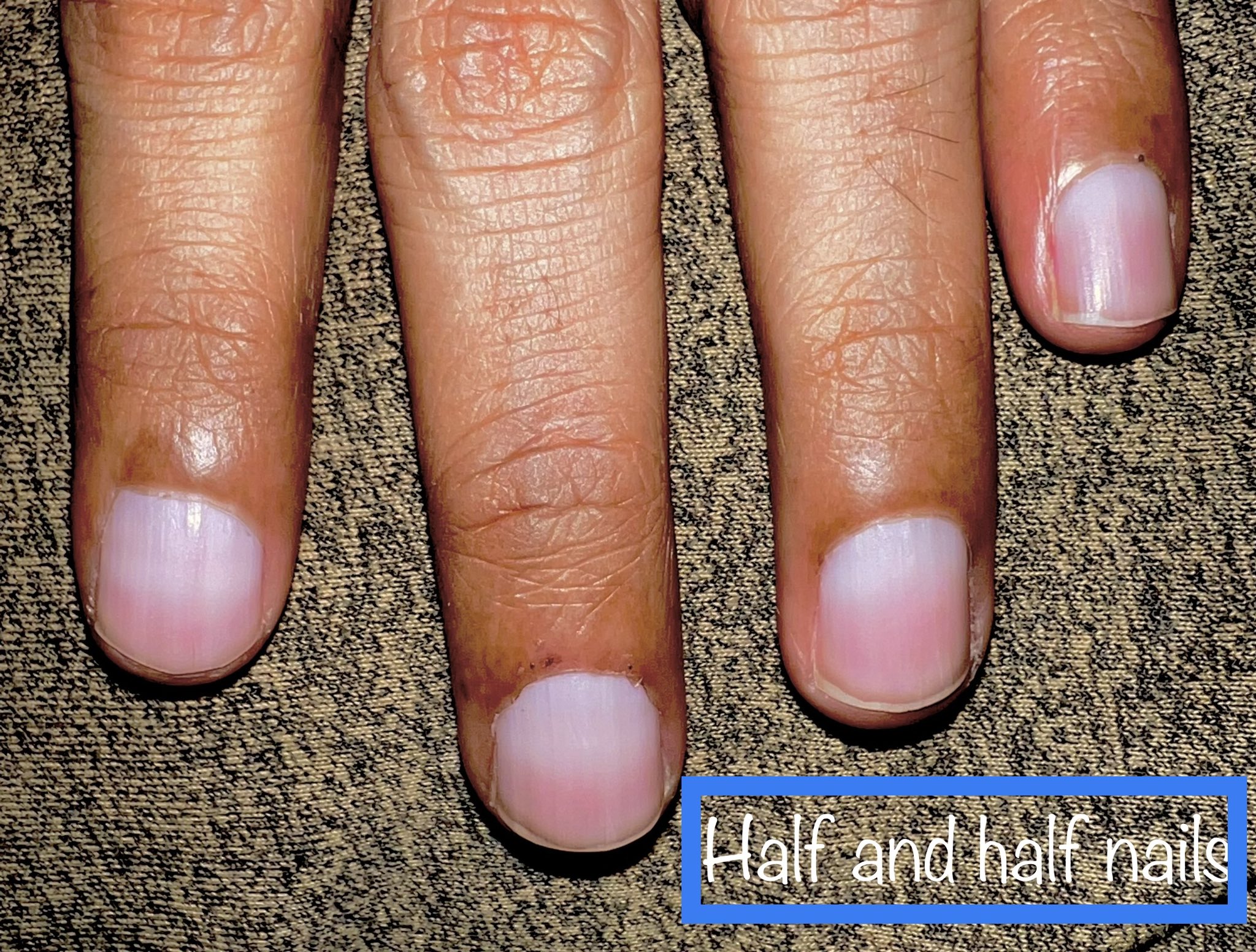 Zinc Deficiency Nails 1,600+ Zinc Nails Stock Photos, Pictures