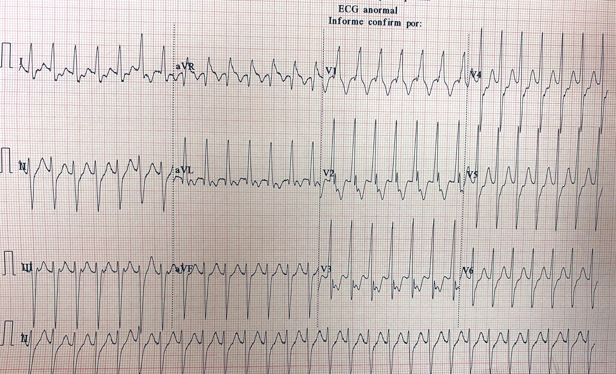 Un Residente de Urgencias on Twitter: "At a glance 👁️¿Is this Narrow or Wide QRS? What do you ...