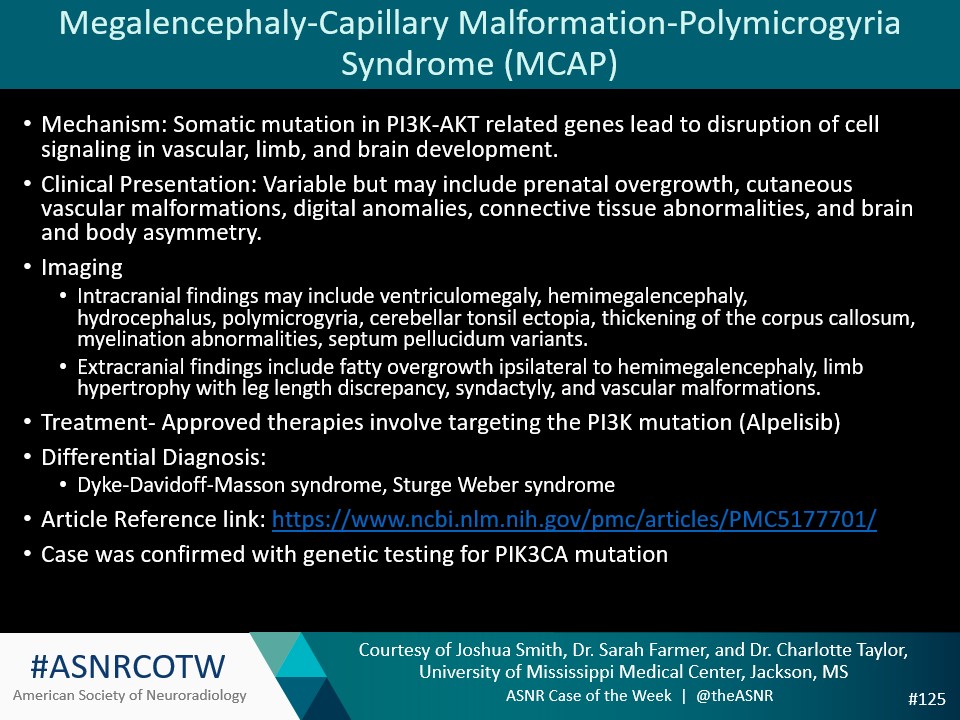 Megalencephaly Capillary Malformation