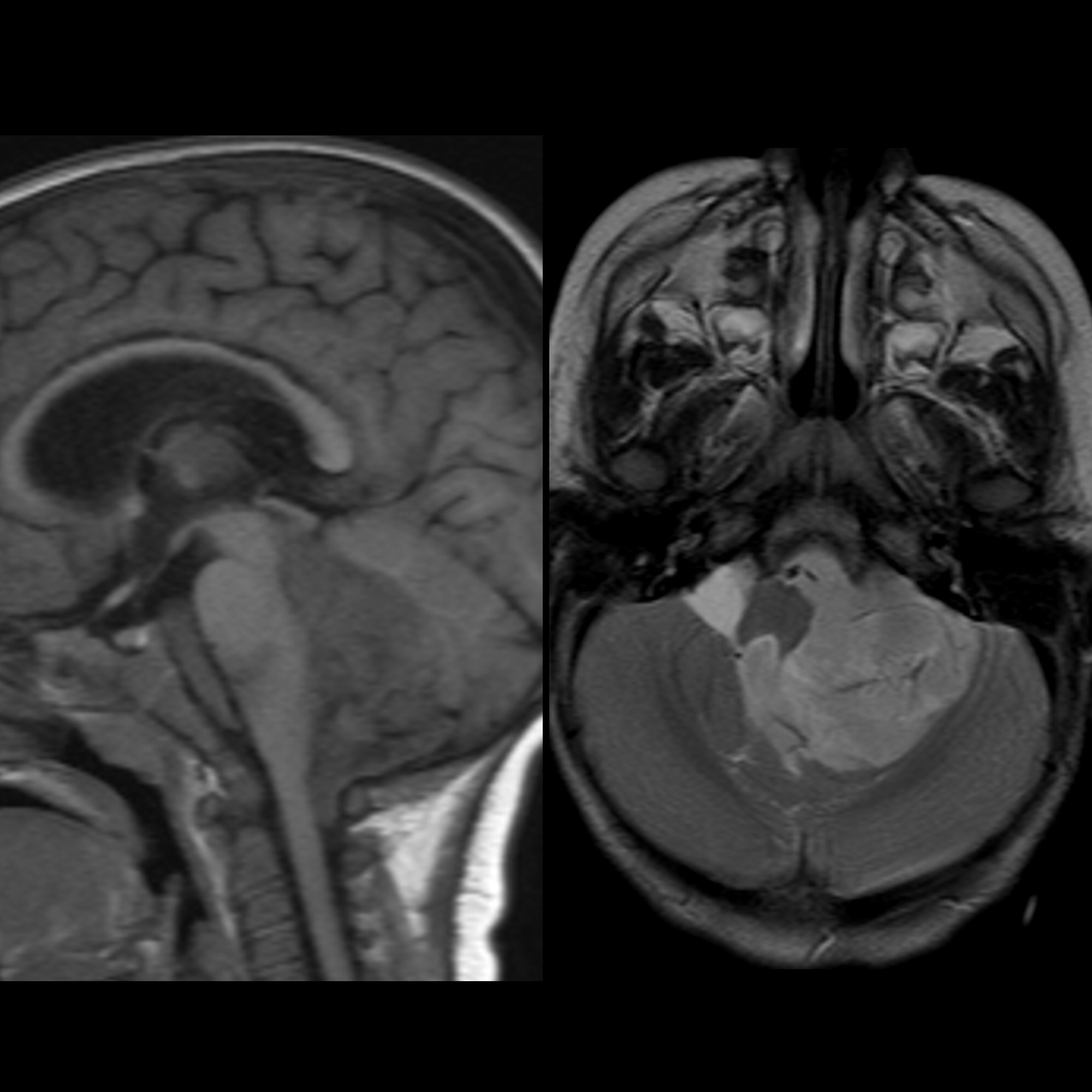 Fourth Ventricle Mri