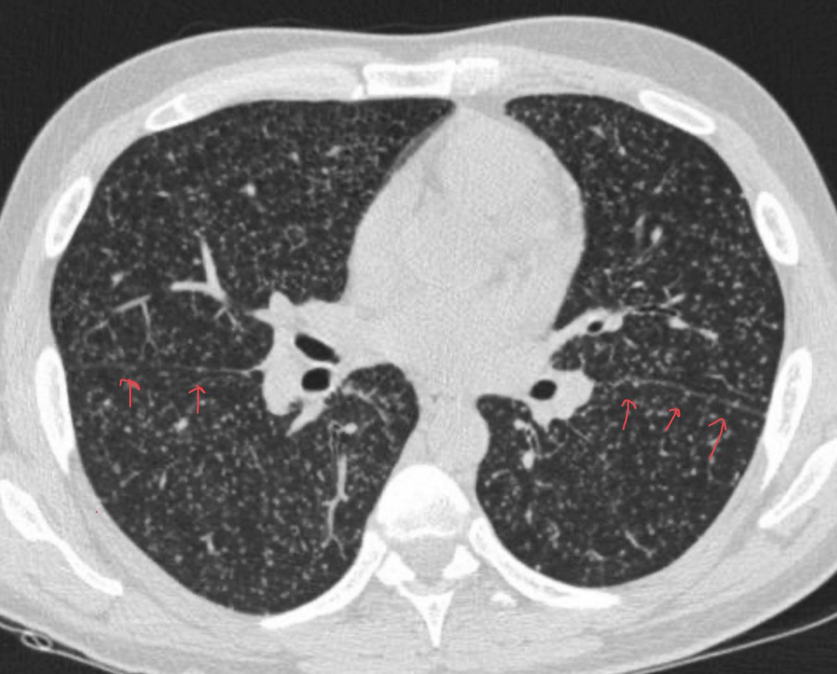 Approaching multinodular lung disease starts by placing the nodules ...