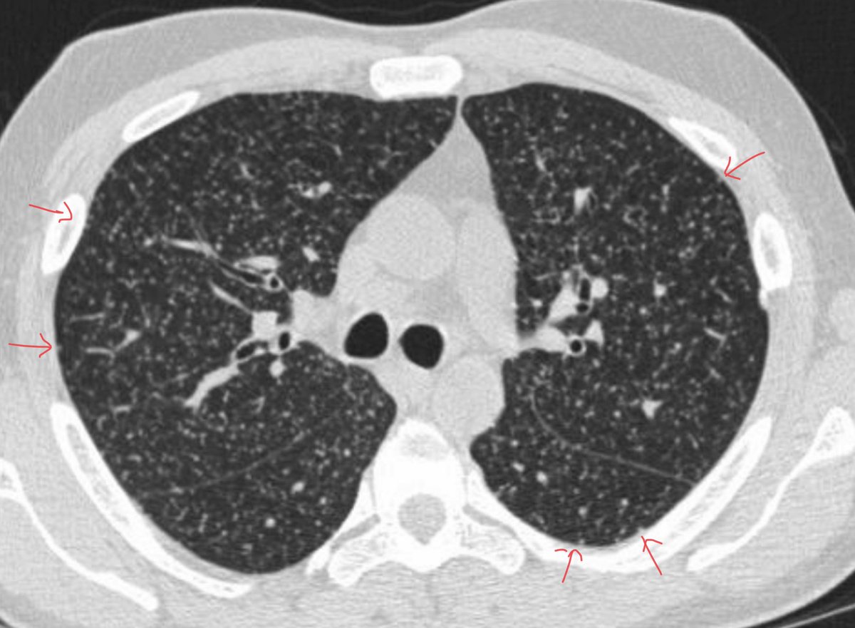 Approaching multinodular lung disease starts by placing the nodules ...
