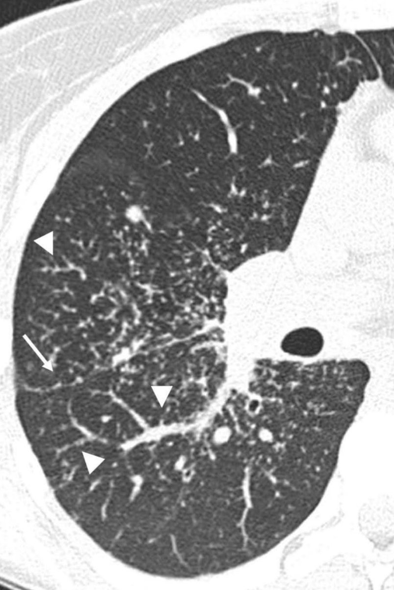 Approaching multinodular lung disease starts by placing the nodules ...