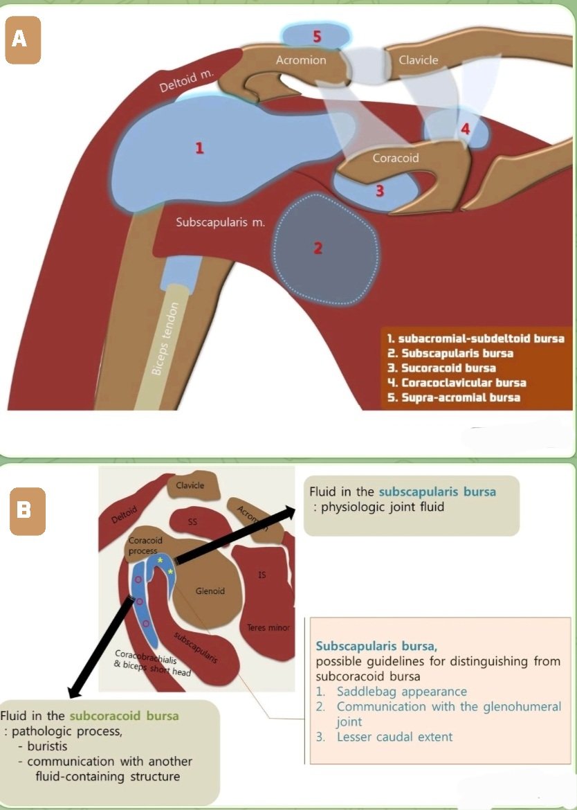 Shoulder Bursa Radiology At Arthur Hitt Blog