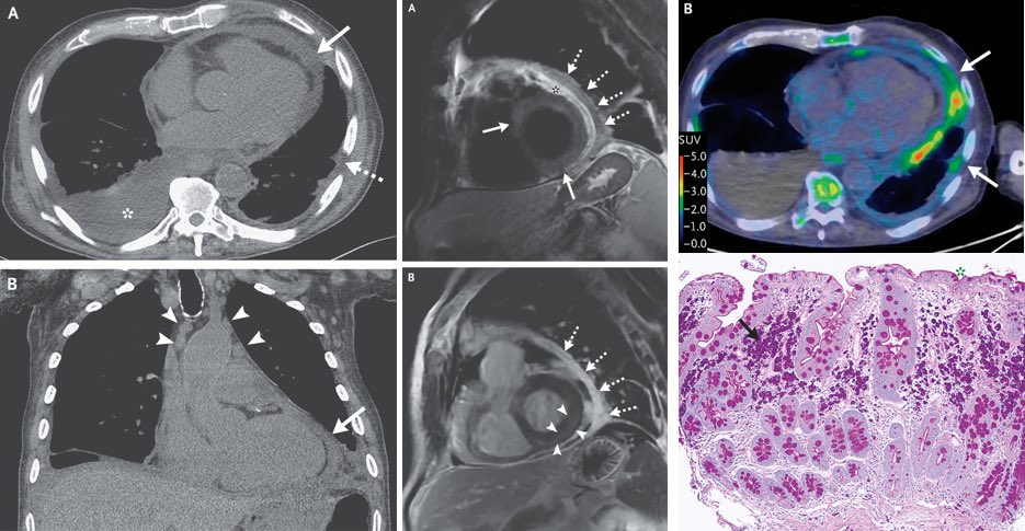 Images of Infectious Diseases Serositis, myopericarditis, abdominal ...