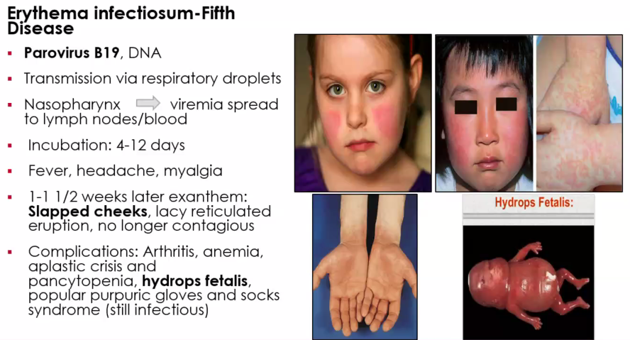 Erythema Infectiosum