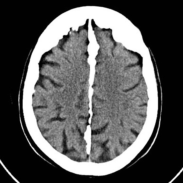 Which part of the brain 🧠 is either partially or completely calcified ...