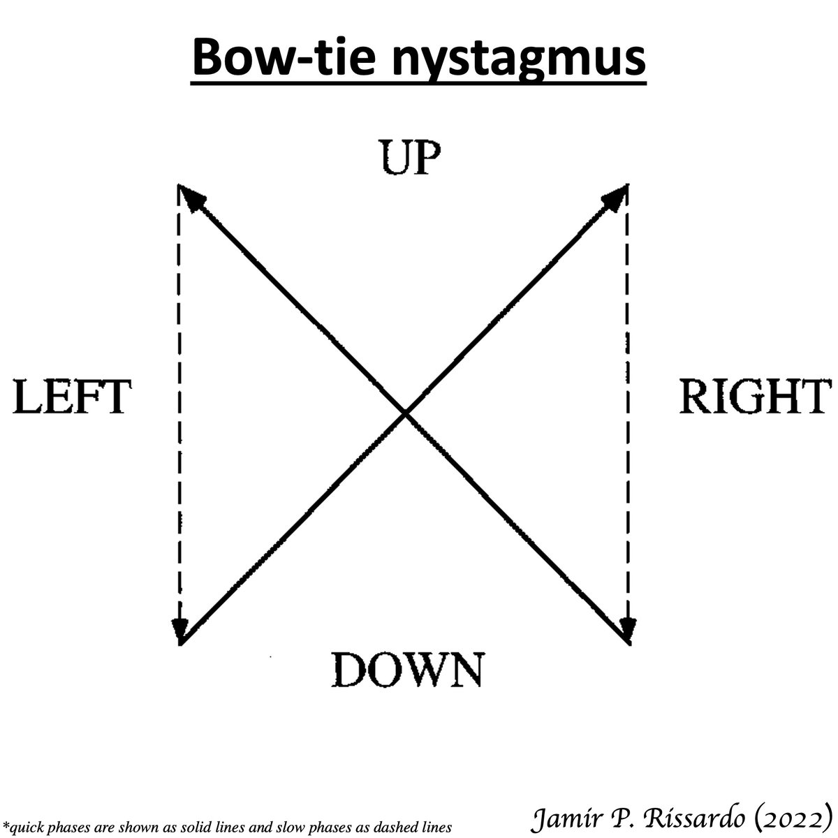 Nystagmus series – Part IV (upbeat nystagmus) “Bruns ataxia, Bruns ...