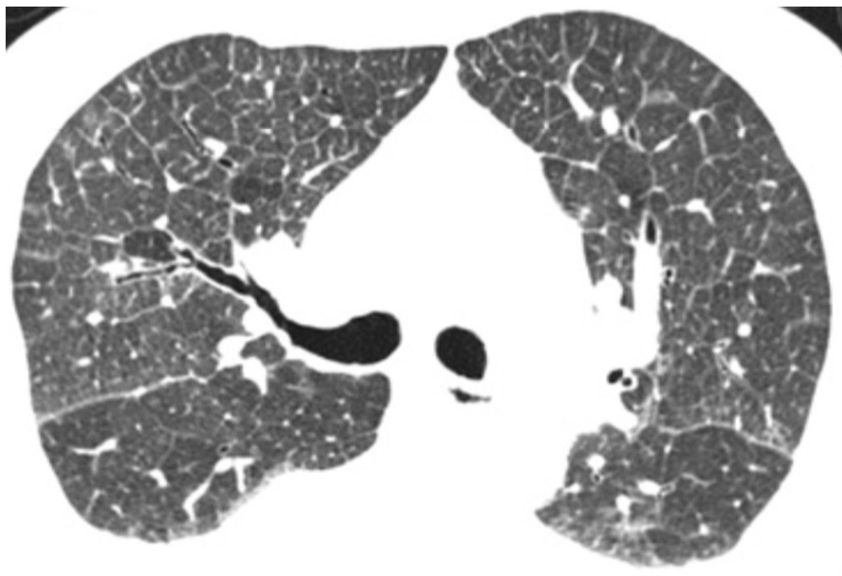 In daily practice, I encounter frequently overlooked interstitial ...