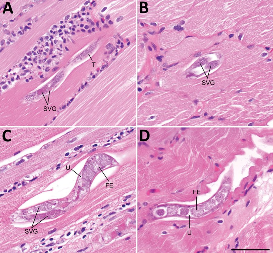 Muscle Atrophy Histology