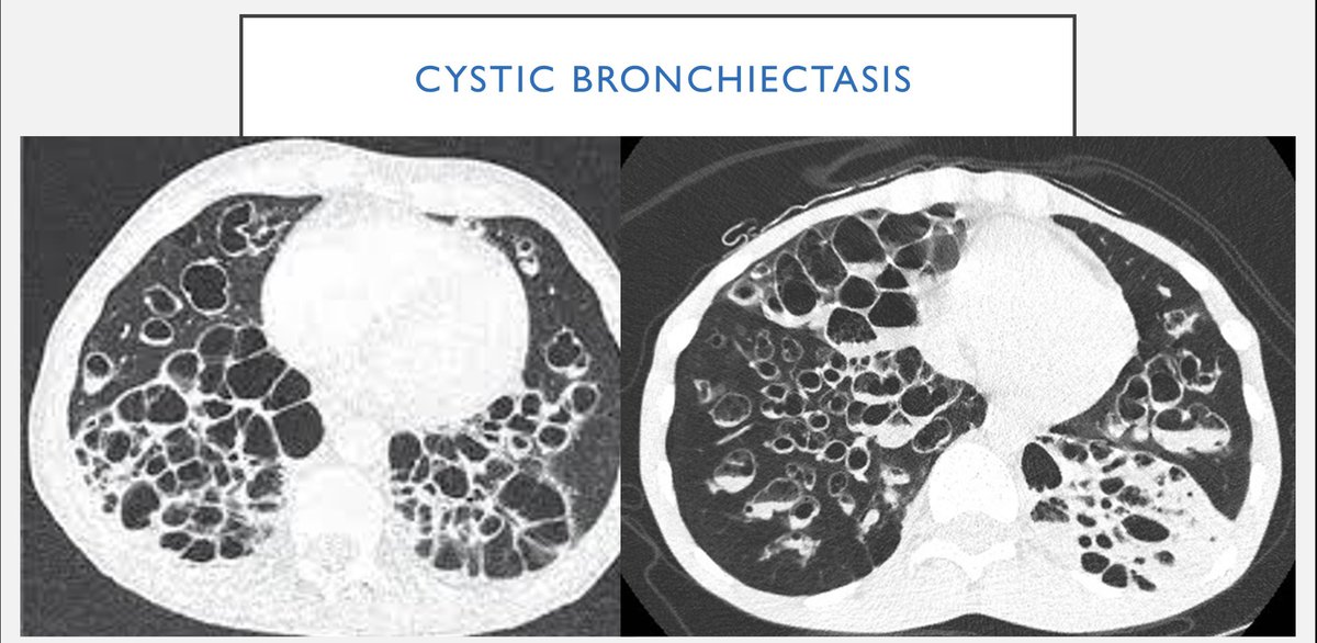 Differential diagnosis of cystic lung are many and inconsistent ...