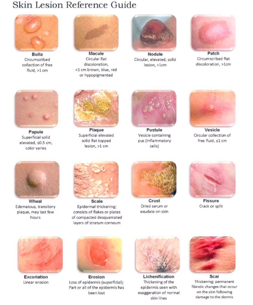 Excoriation Skin Lesion