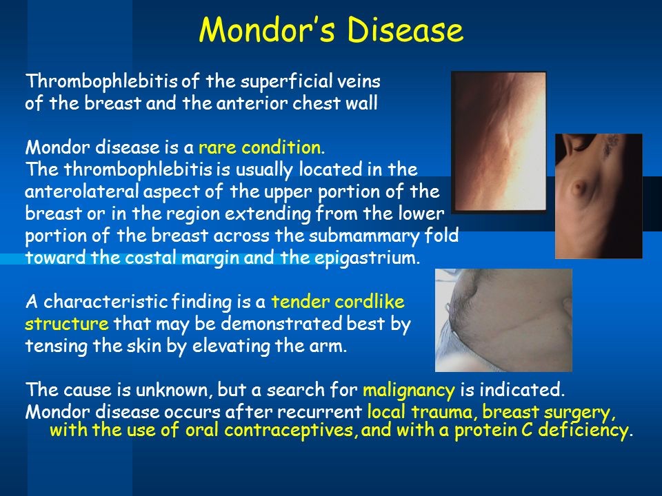 Mondors Disease