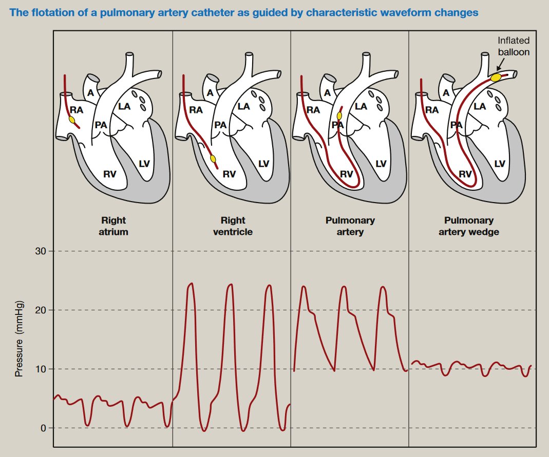 Pulmonary Artery Catheter Waveforms
