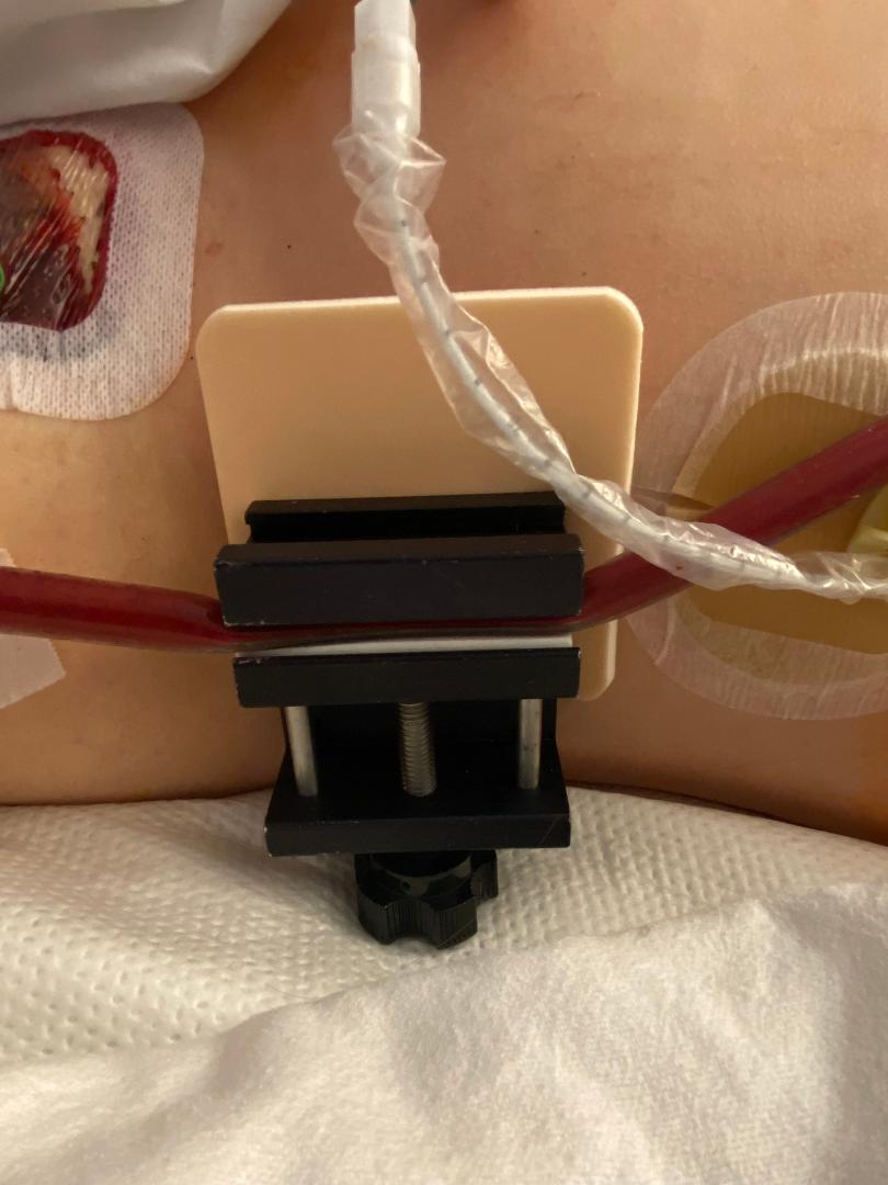 Today's short 🧵 is on the Hoffman clamp, a device that may only be of ...