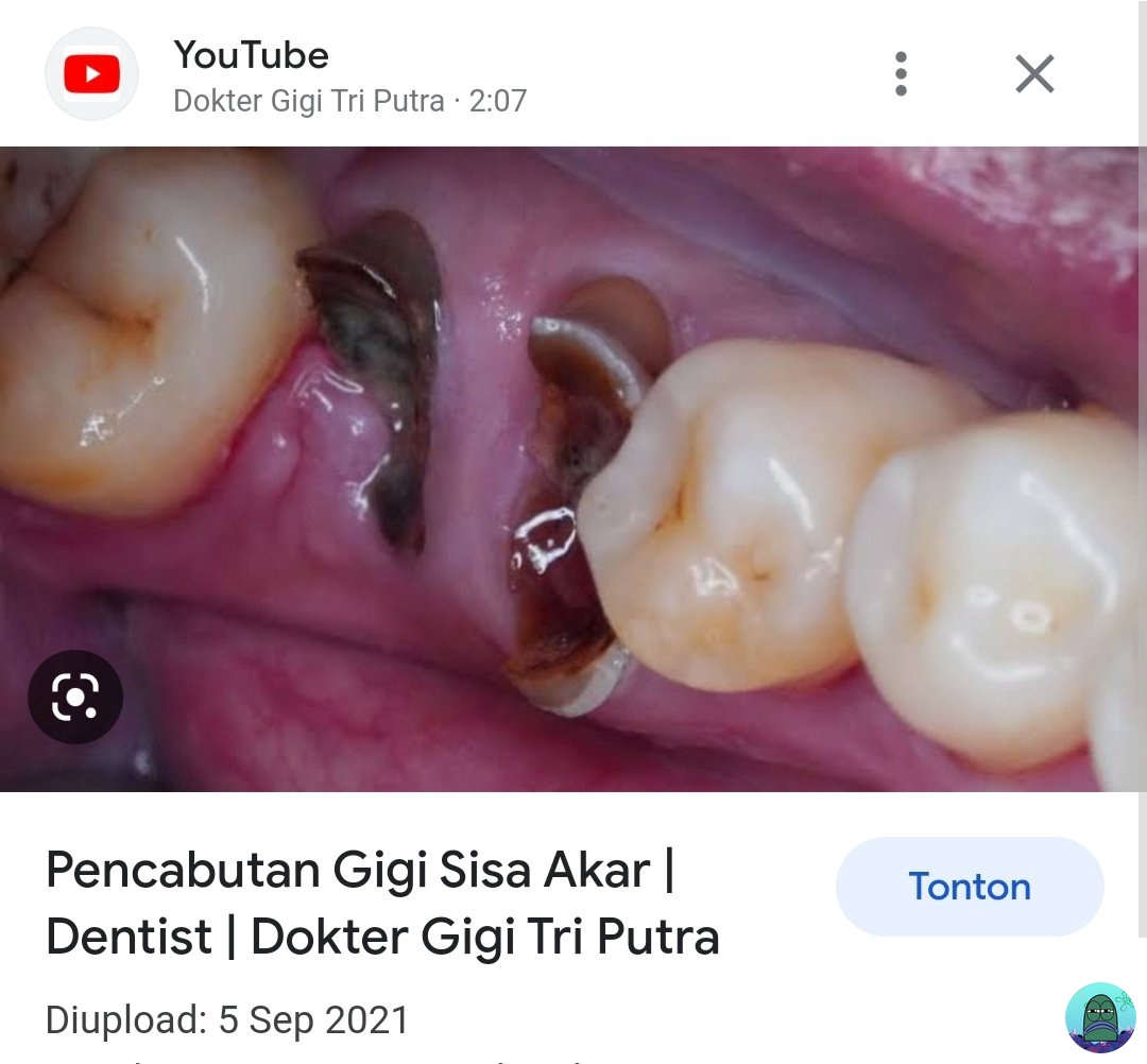 GA TanyarlxPerspirex di Likes 🔥 on Twitter: "Tanyarl CW// akar gigi hitam bolong Guys ada yang ...