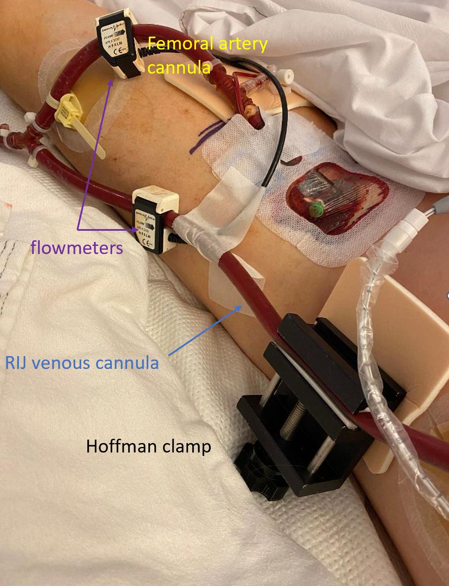 Today's short 🧵 is on the Hoffman clamp, a device that may only be of ...