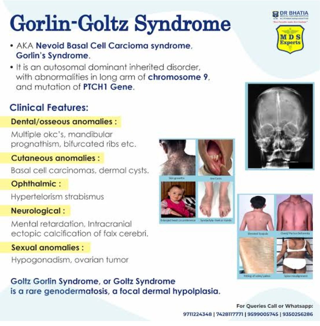 Gorlin Syndrome Symptoms Nevoid Basal Cell Carcinoma Syndrome