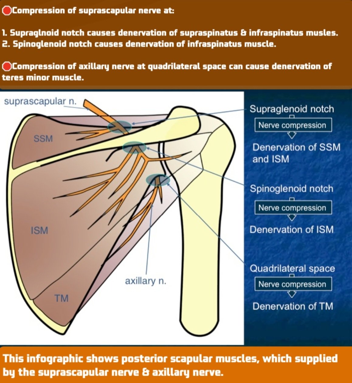 Spinoglenoid Notch Spinoglenoid Notch