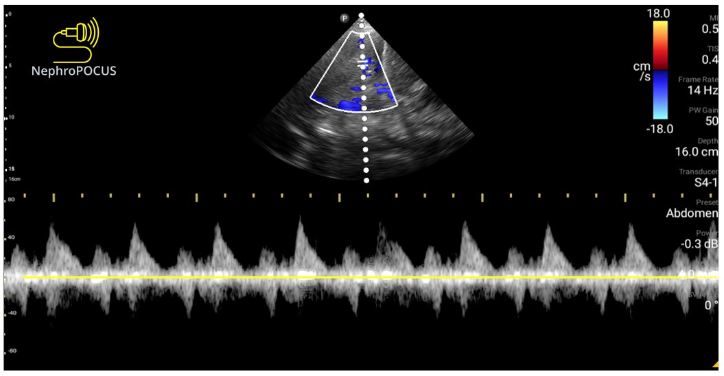 Dynamic or static air bronchograms? Clinical: AKI, ?fluid overload ...