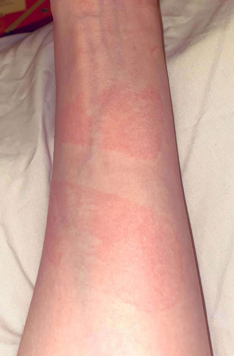 Kathrina Visitkarte On Twitter RT caej90 Wondered Why My Arm Was kathrina-visitkarte-on-twitter-rt-caej90-wondered-why-my-arm-was