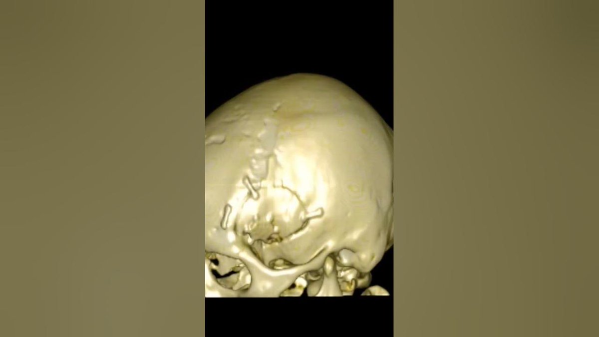 Julio Pereira - Neurocirurgião SP on Twitter: Julio Pereira - Neurocirurgião SP on Twitter: