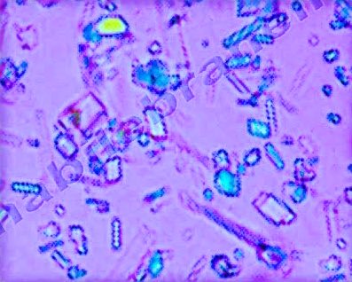 Studying Medicine on Twitter: "Calcium pyrophosphate arthritis (pseudogout or acute CPP ...