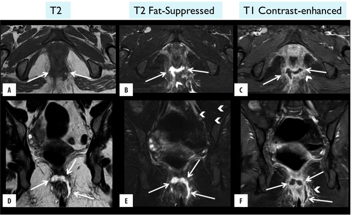 Perianal Crohn's. Definitions: - fistula: chronic tract of granulation ...