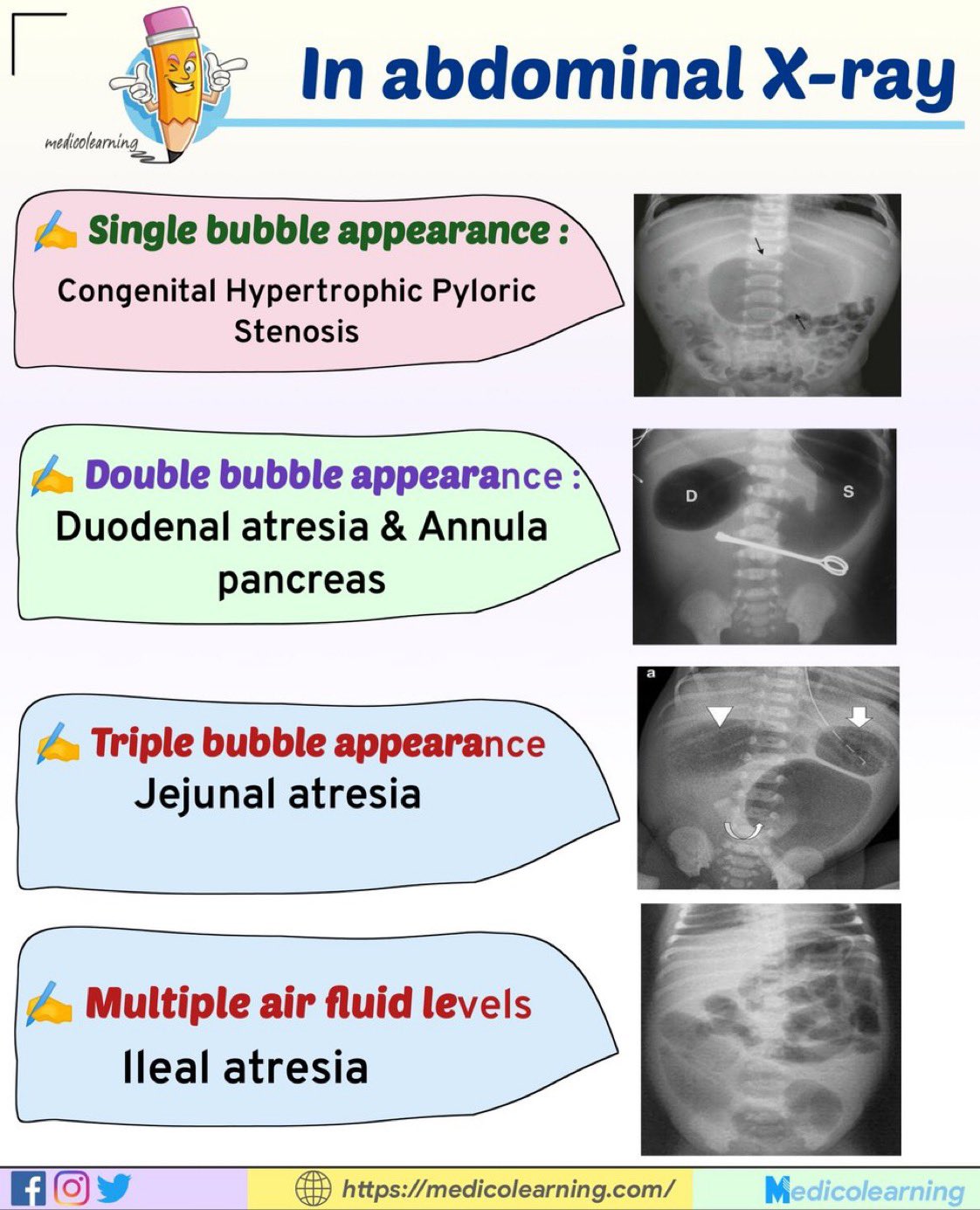 Pyloric Stenosis X Ray