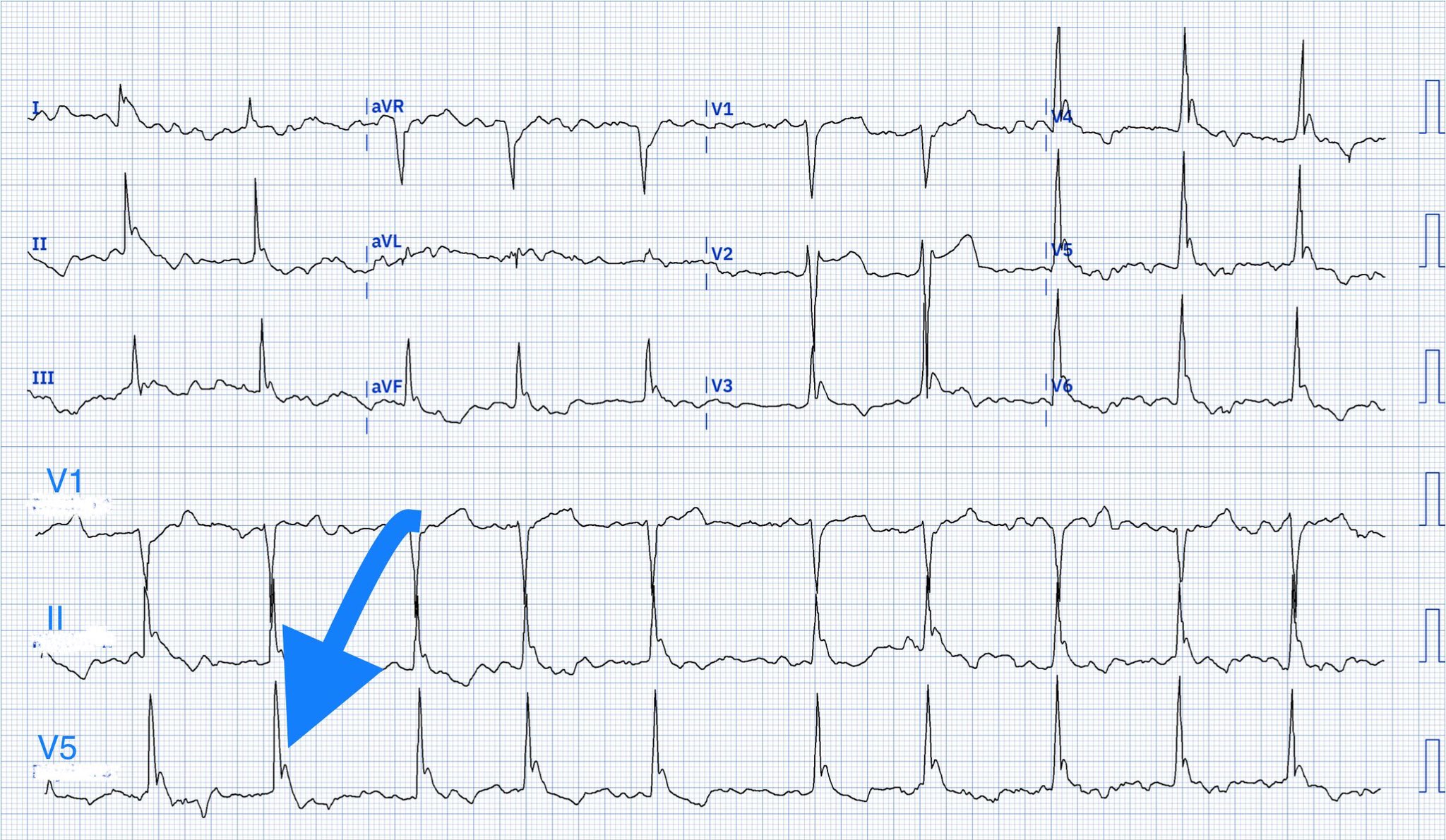 Osborne Waves An Abnormal Electrocardiogram In A Hypothermic Man