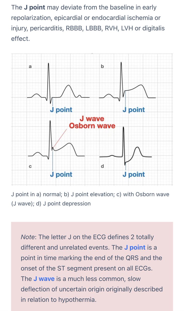 Here’s an ECG with a pathognomonic finding that everyone ought to know, especially at this time ...