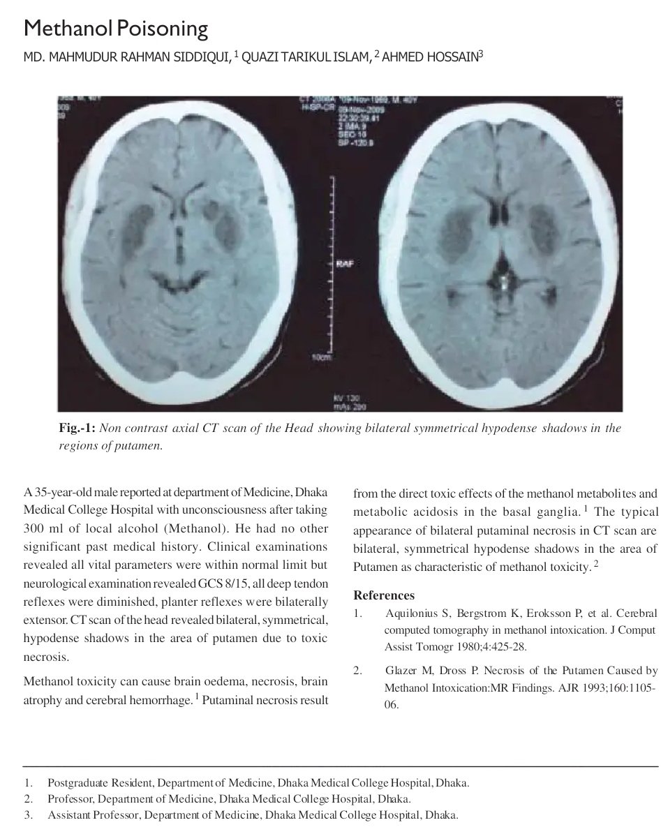 Effects Of Methanol Toxicity